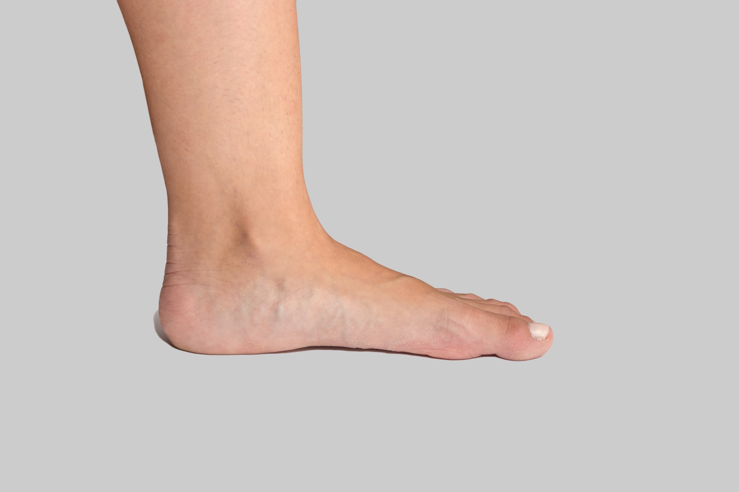 Flat Foot: Causes, Symptoms and Treatments