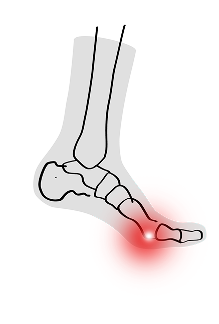 Metatarsalgia: Causes, Symptoms and Treatments